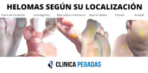 Tengo un callo en el pie ¿Qué hago? – Clínica Pegadas